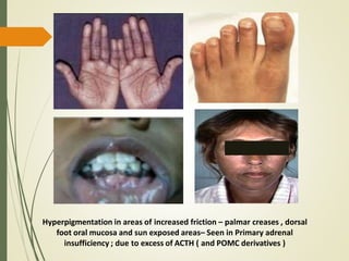 Hpofunction of adrenal cortex | PPTX