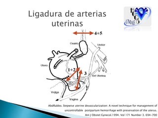 Ligadura de arterias uterinas | PPTX