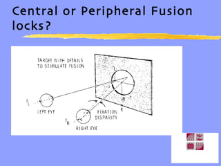 fixation disparity | PPT