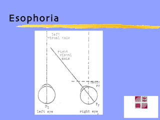Heterophoria | PPT