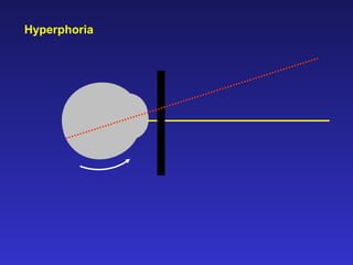 Heterophoria2 | PPT