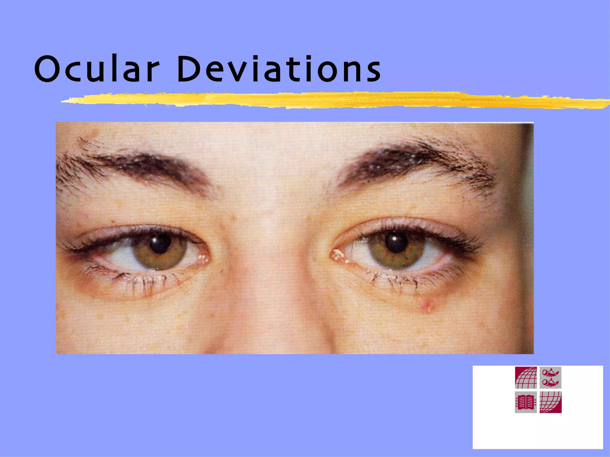 ocular Deviations | PPT