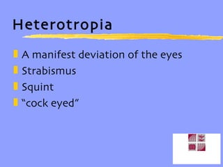 ocular Deviations | PPT