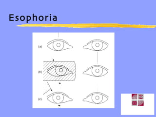 ocular Deviations | PPT