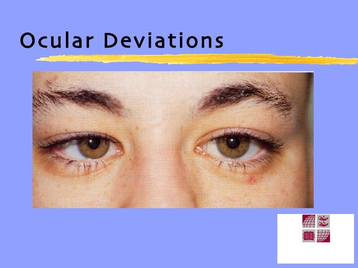 ocular Deviations