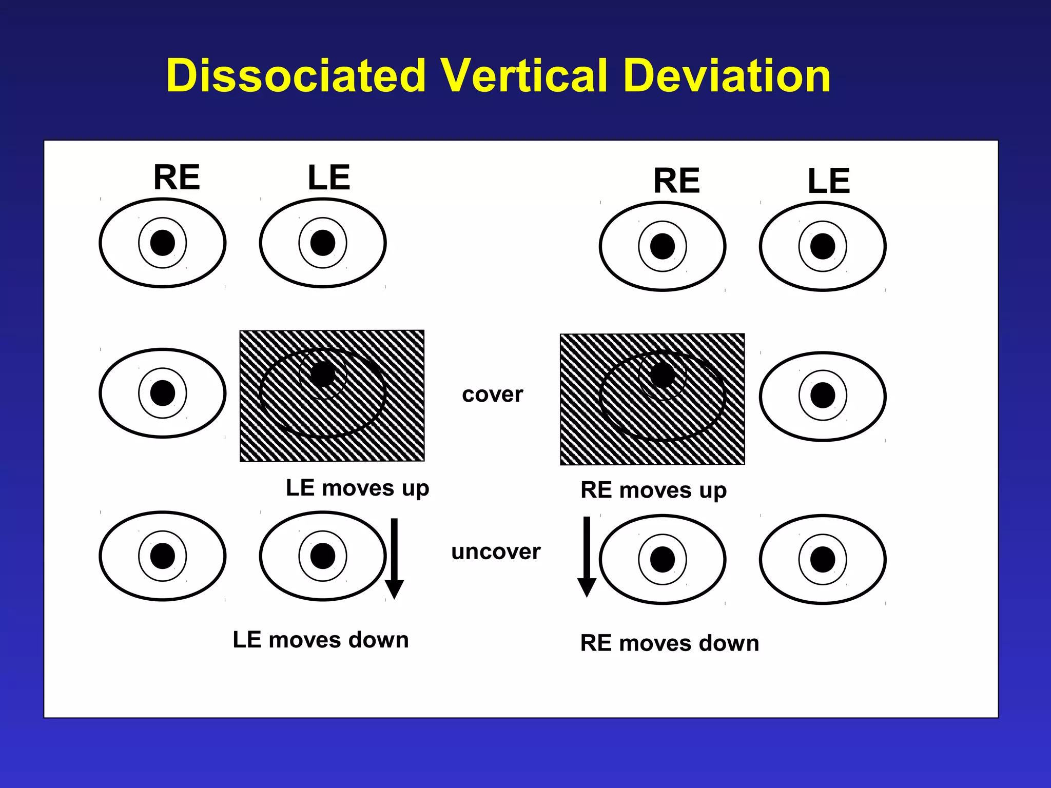 Hpptfilesbradfordresourcesbinocularfilesverticaldeviations 090317000106-phpapp02 | PPT
