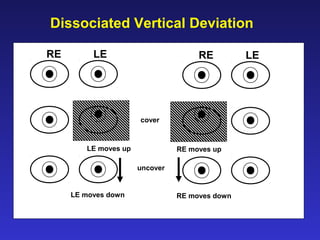 Hpptfilesbradfordresourcesbinocularfilesverticaldeviations 090317000106 ...