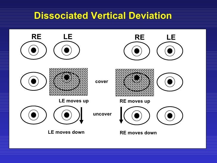 Vertical Deviations