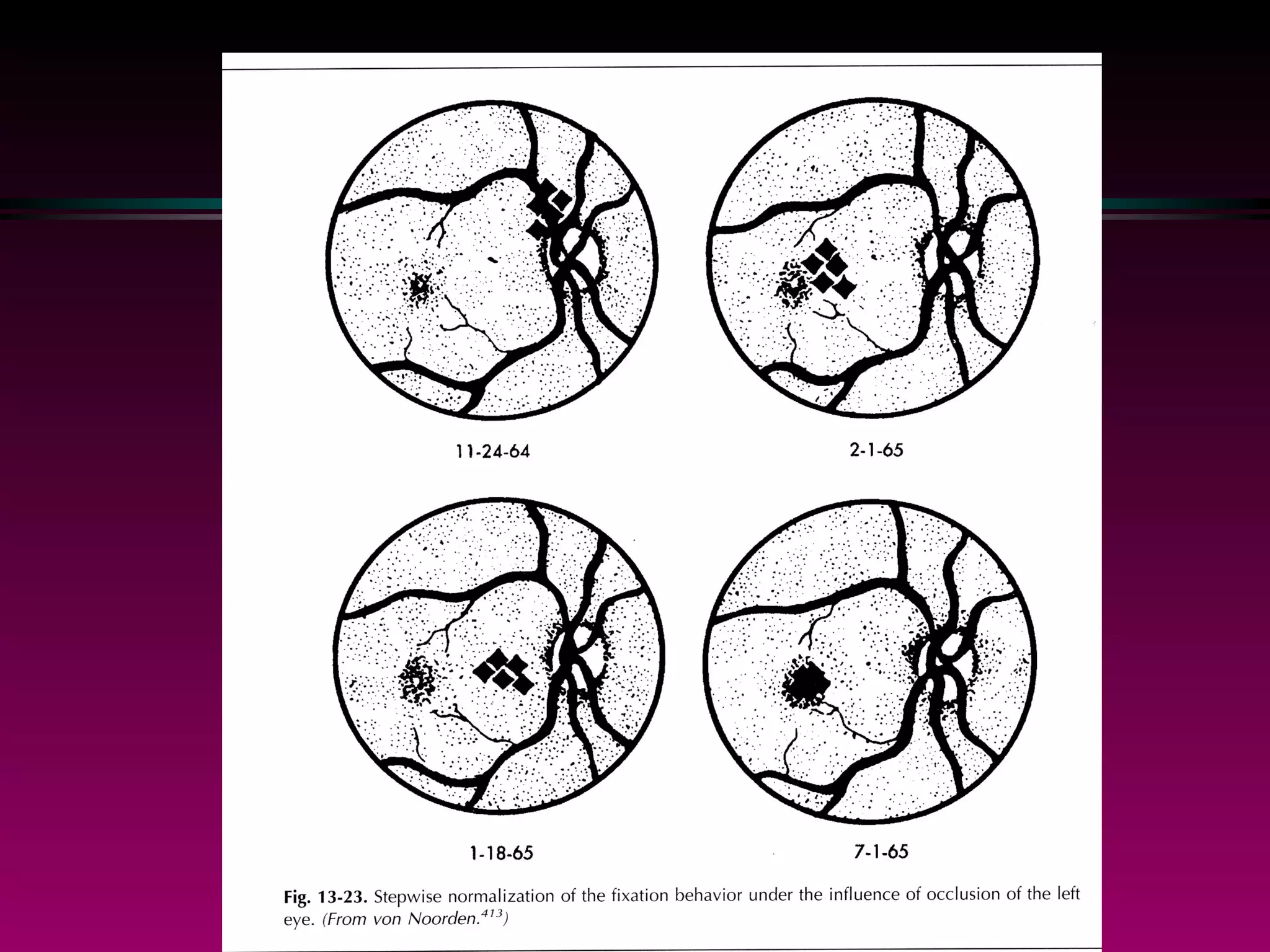 Eccentric Fixation | PPT