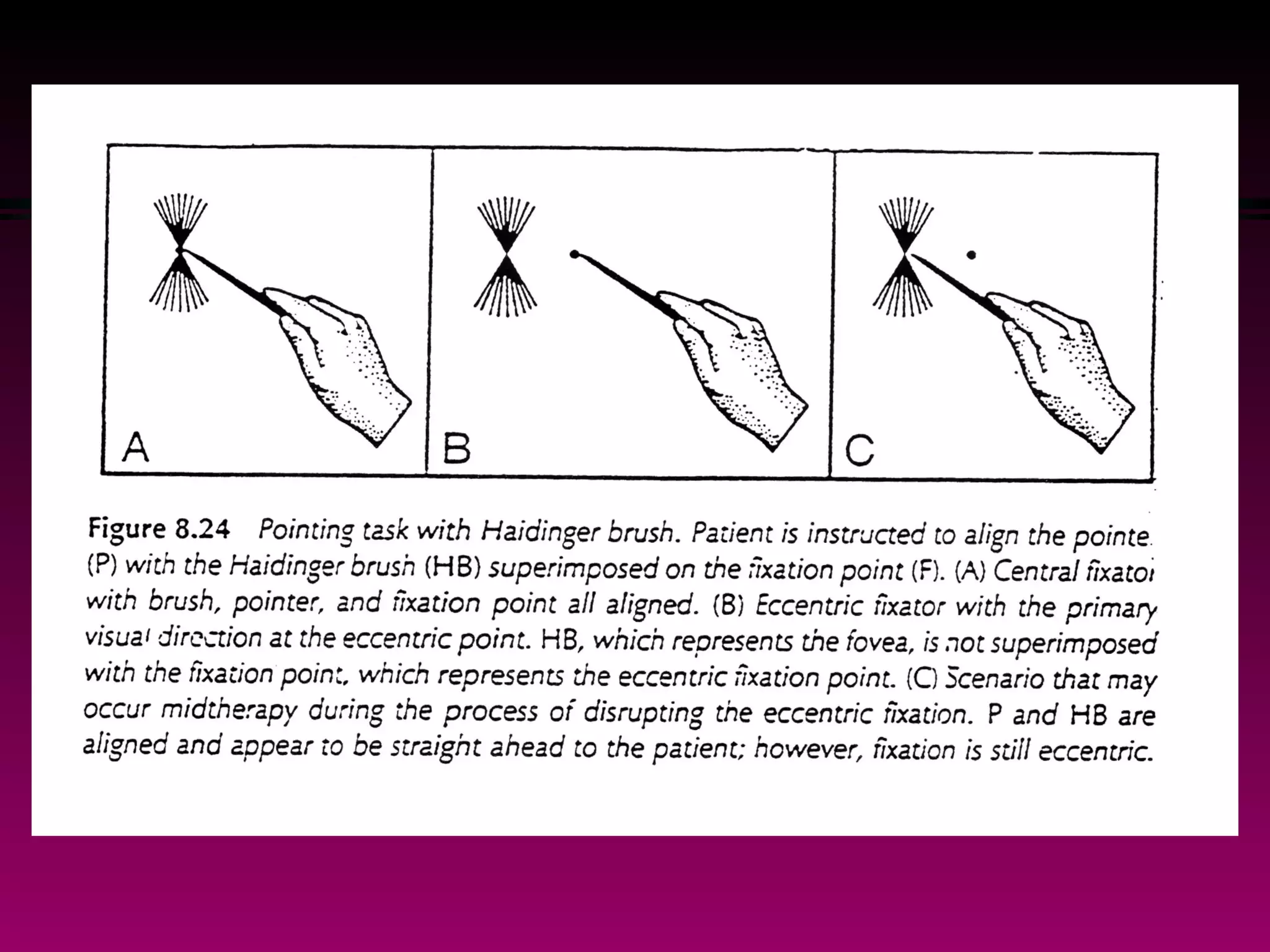 Eccentric Fixation | PPT