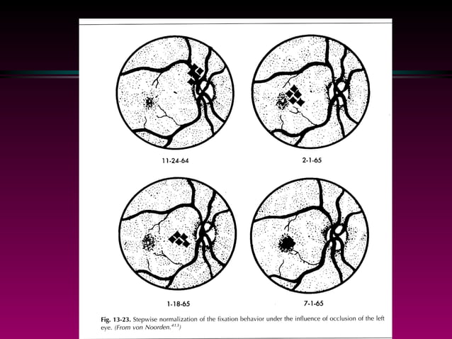 Eccentric Fixation | PPT