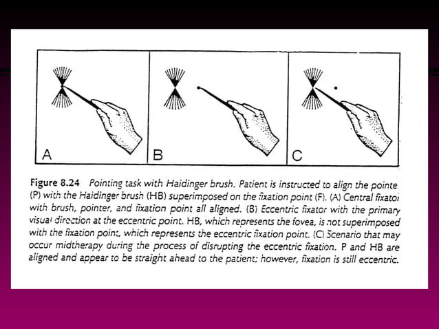 Eccentric Fixation | PPT
