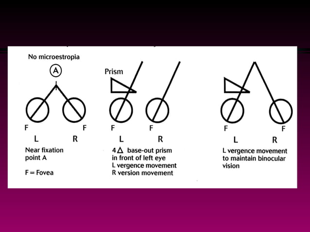 Eccentric Fixation | PPT