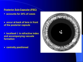 Assessment & management of patients with cataract | PPT