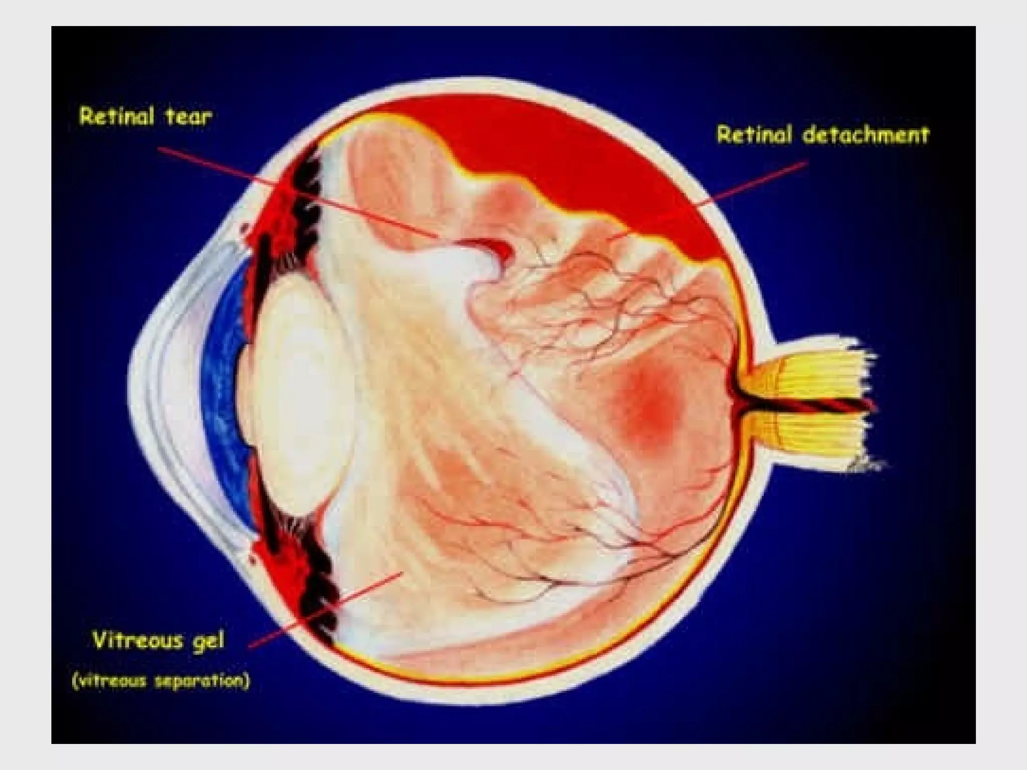 DISORDERS OF THE VITREOUS AND RETINAL DETACHMENT | PPT