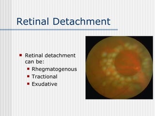 DISORDERS OF THE VITREOUS AND RETINAL DETACHMENT | PPT