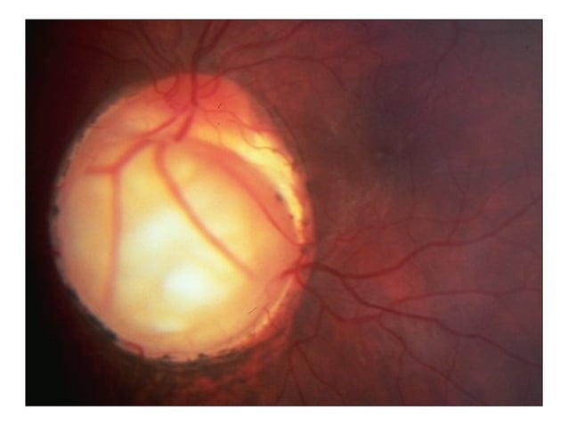 Neuro-ophthalmology | PPT