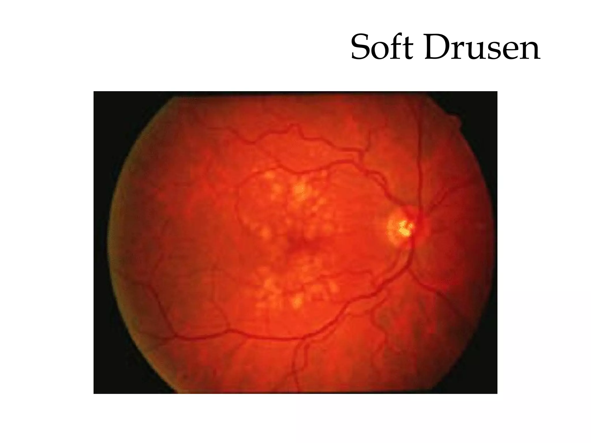 Age-Related Macular Degeneration | PPT