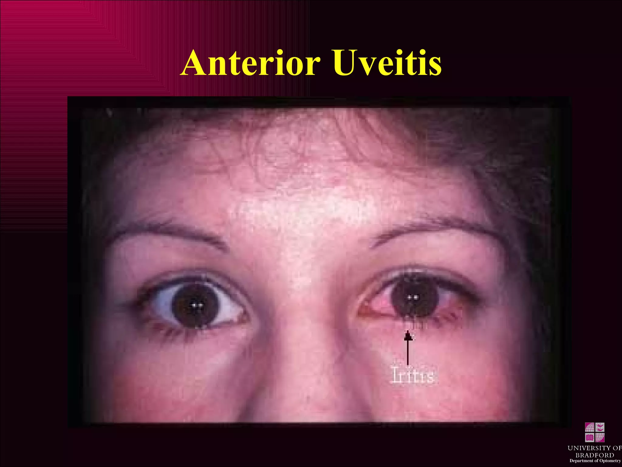 Anterior Uveitis | PPT