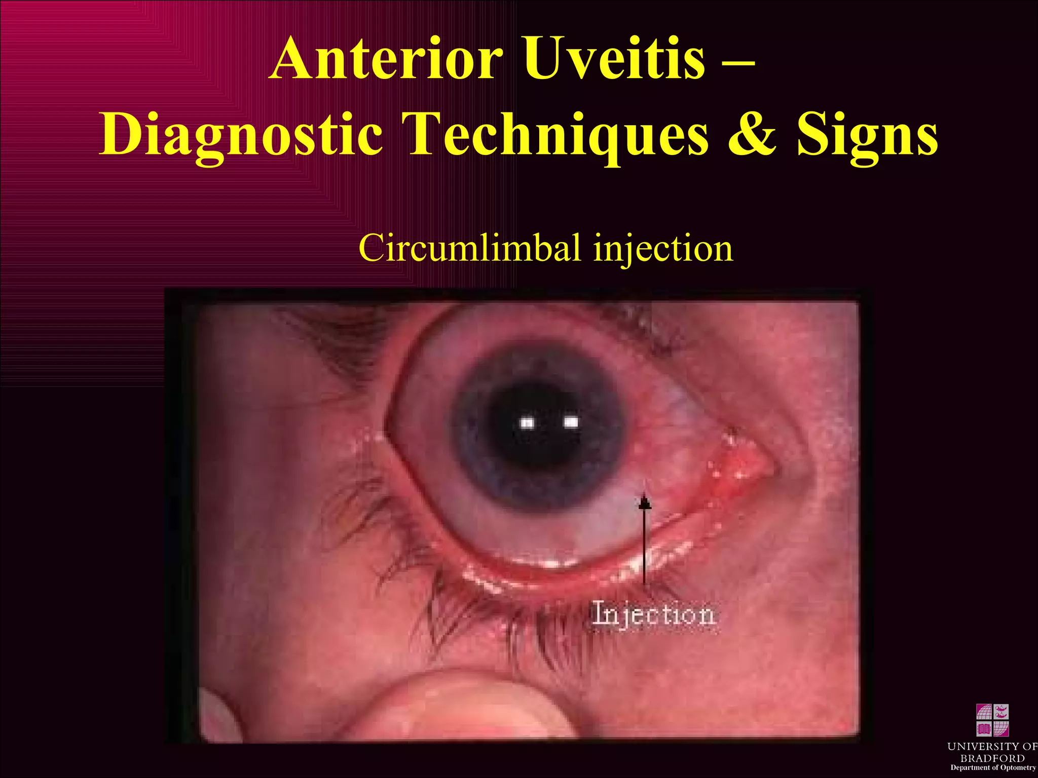 Anterior Uveitis | PPT