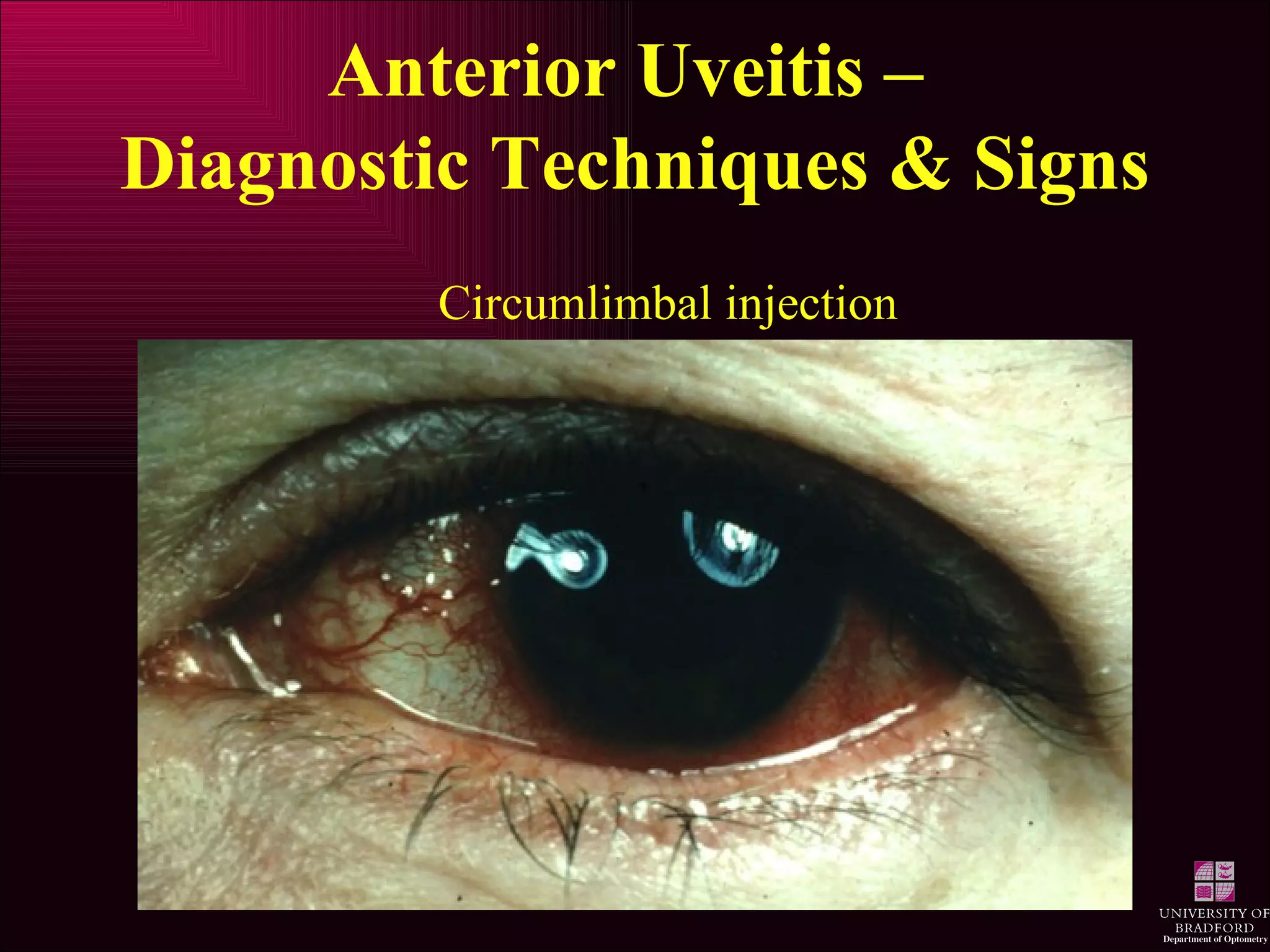 Anterior Uveitis | PPT