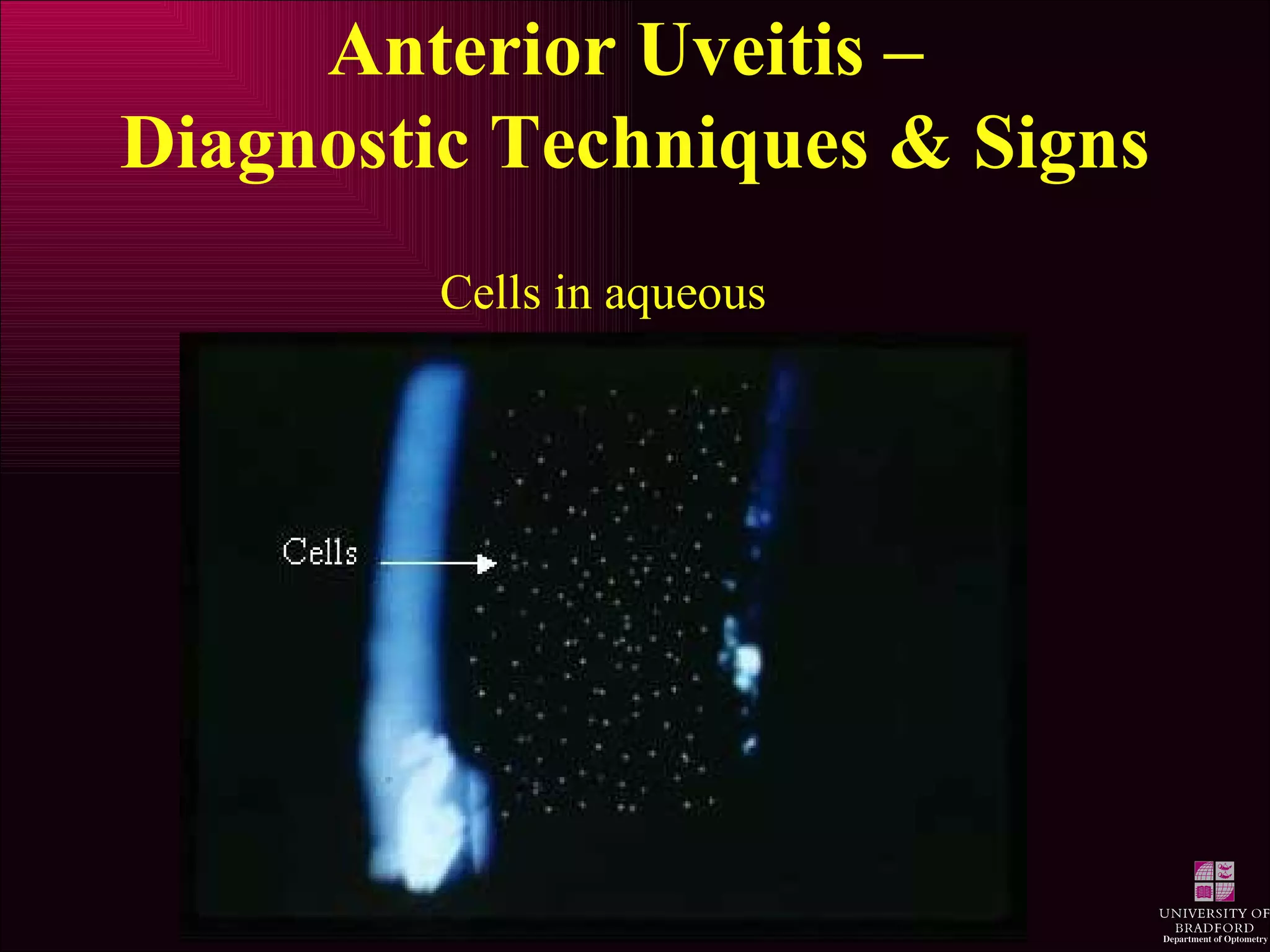Anterior Uveitis | PPT
