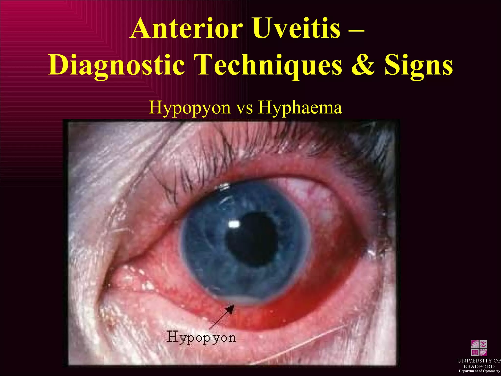 Anterior Uveitis | PPT