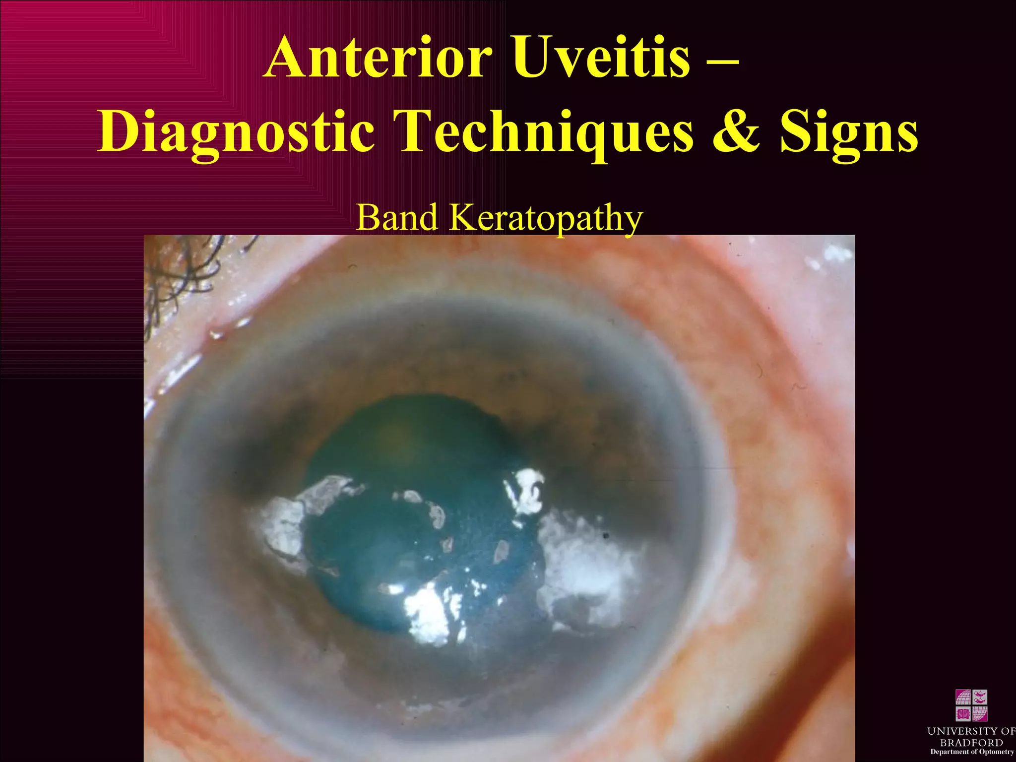 Anterior Uveitis | PPT