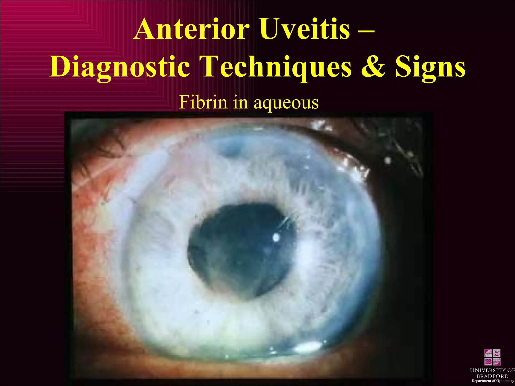 Anterior Uveitis | PPT