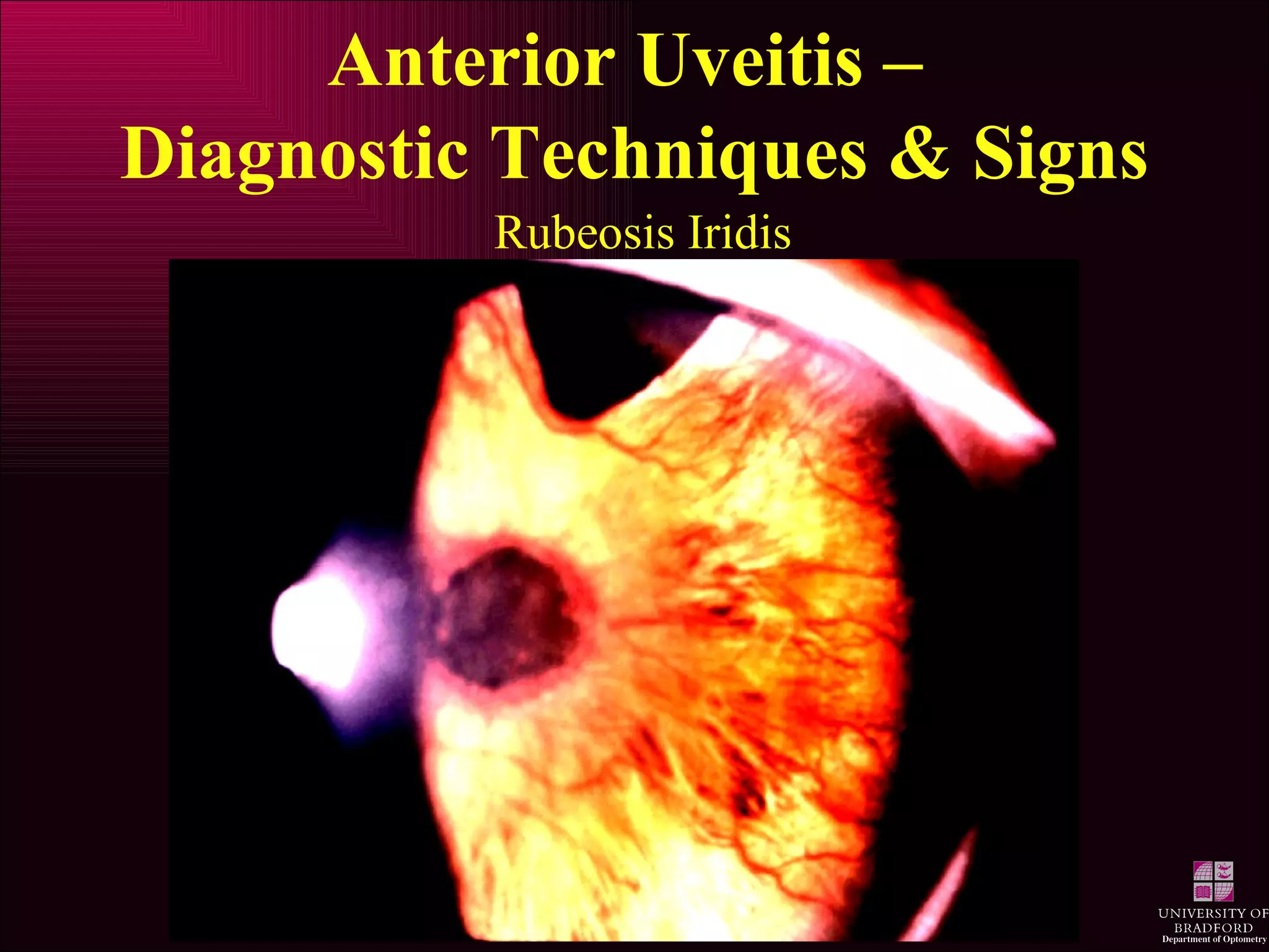 Anterior Uveitis | PPT