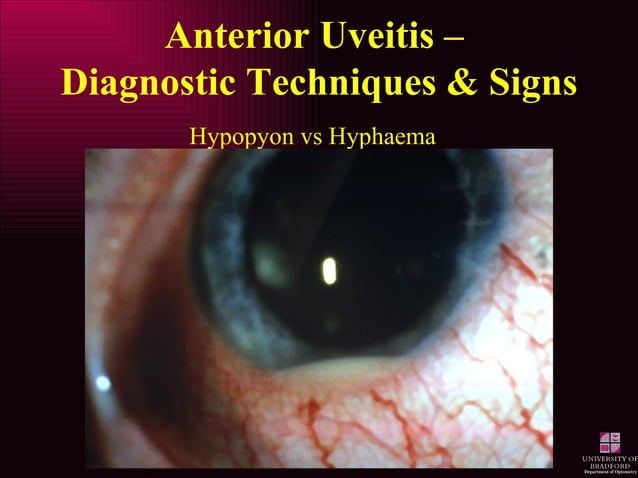 Anterior Uveitis | PPT