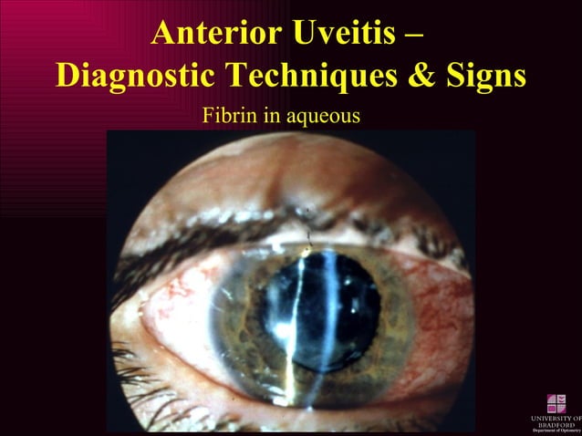 Anterior Uveitis | PPT