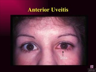 Anterior Uveitis