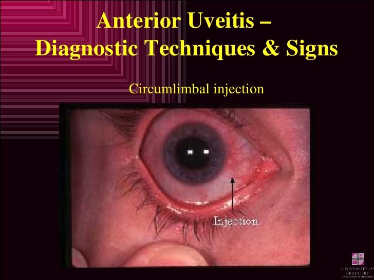 Anterior Uveitis