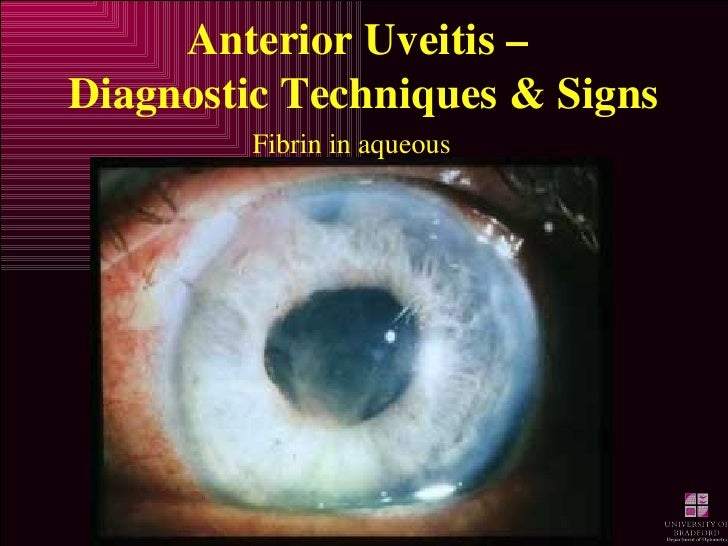 Anterior Uveitis