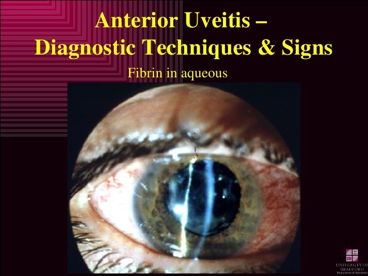 Uveitis Anterior