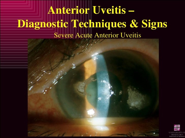 Anterior Uveitis