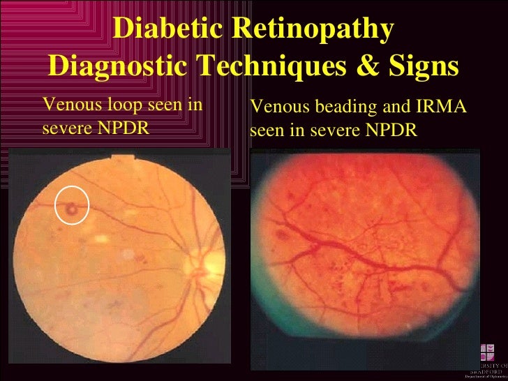 Diabetic Eye Disease