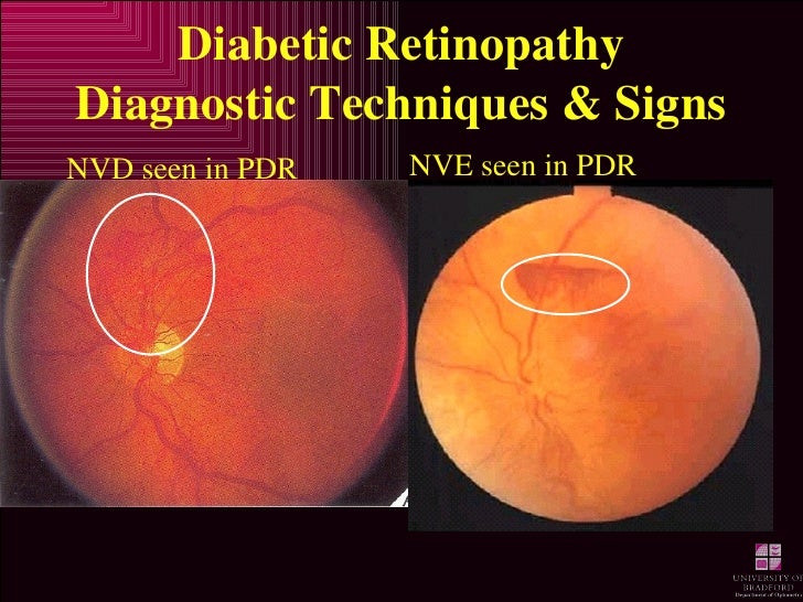 Diabetic Eye Disease