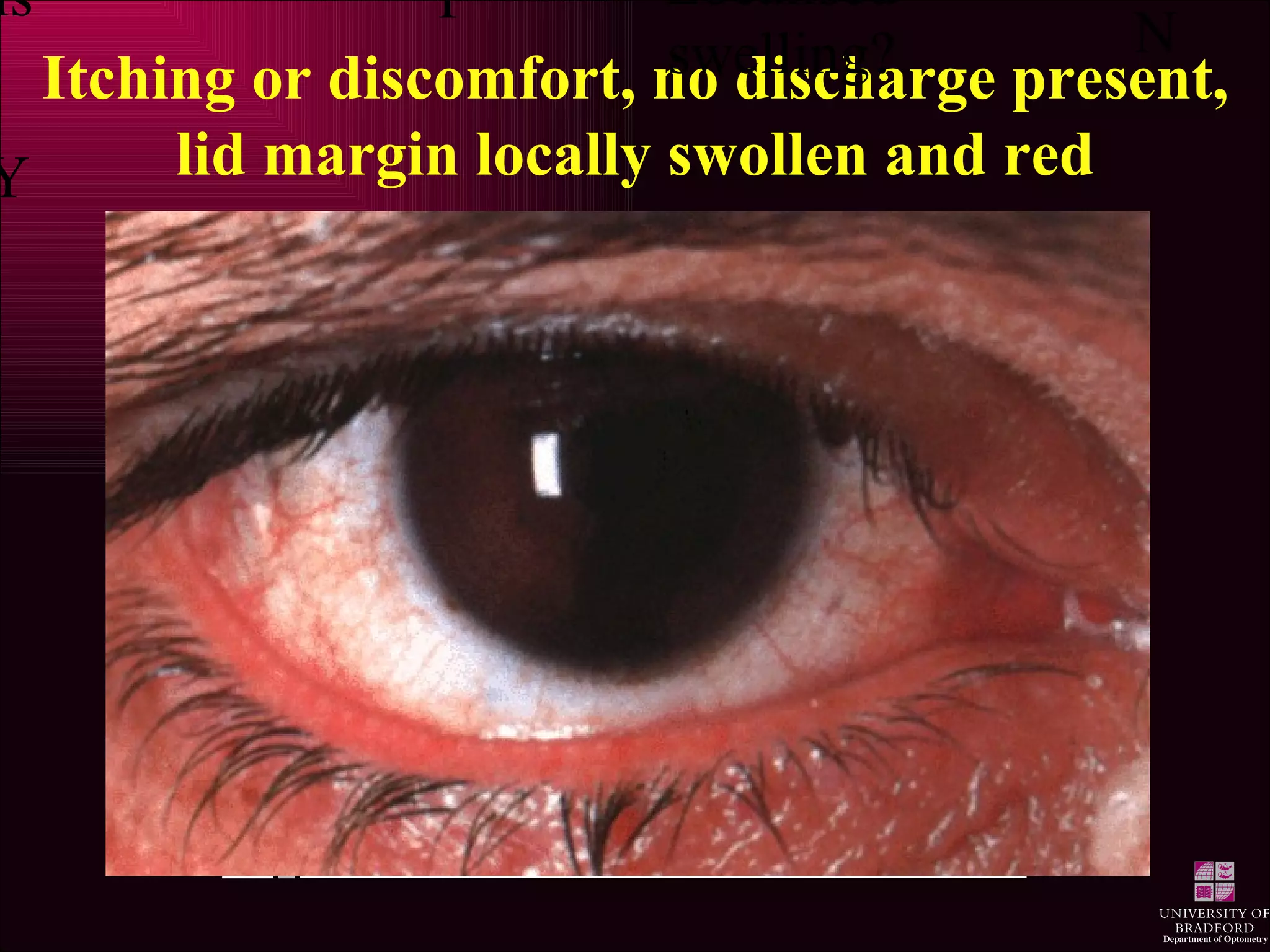 Differential Diagnosis of Red Eye | PPT