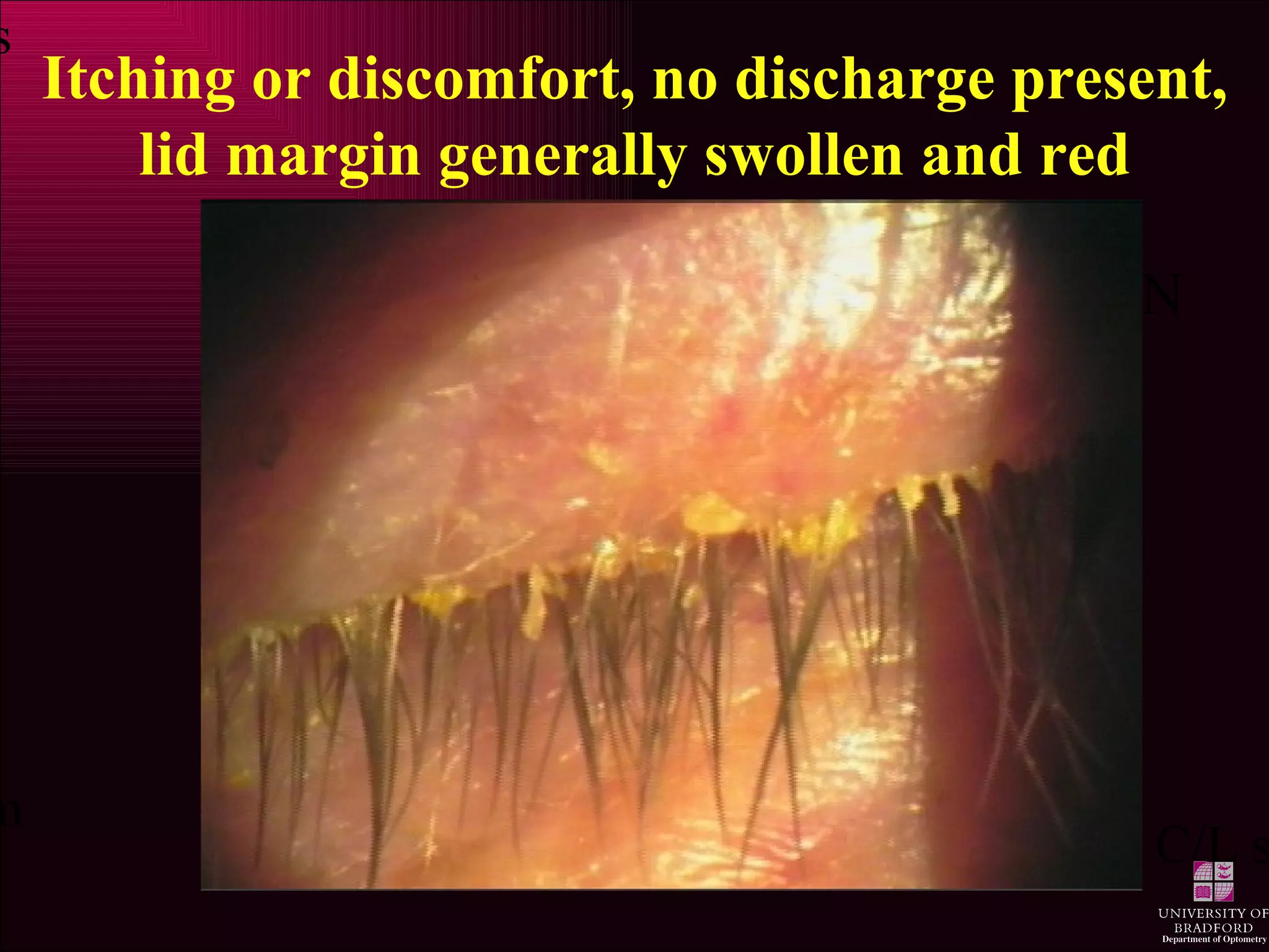 Differential Diagnosis of Red Eye | PPT