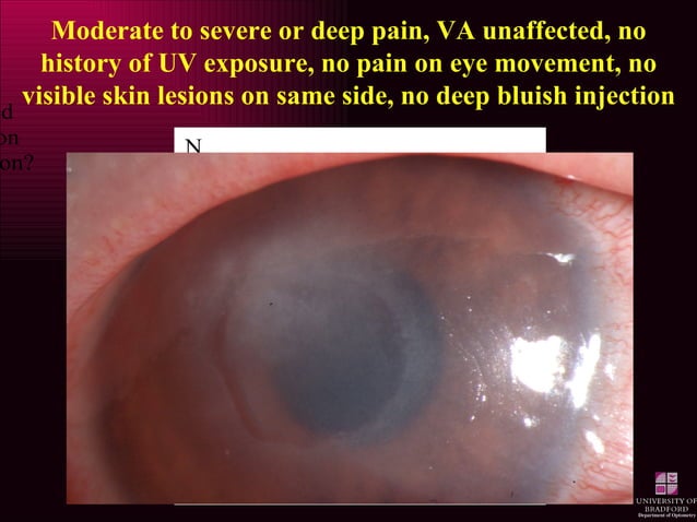 Differential Diagnosis of Red Eye | PPT
