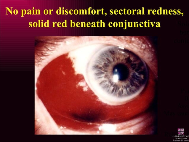 Differential Diagnosis of Red Eye | PPT