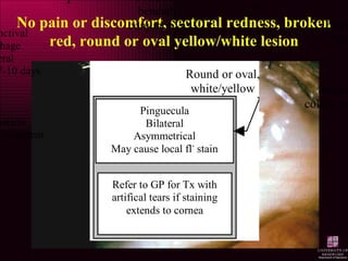 Differential Diagnosis of Red Eye | PPT