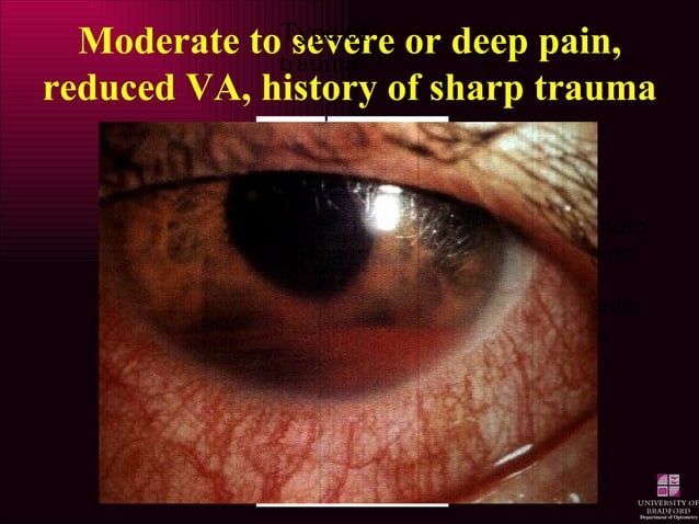 Differential Diagnosis of Red Eye | PPT