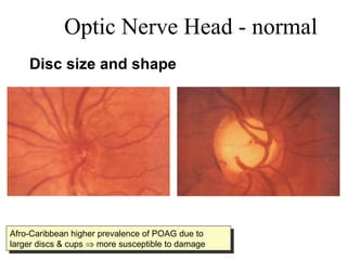 Glaucoma | PPT