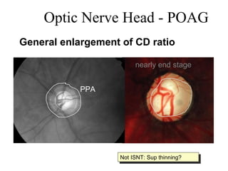 Glaucoma | PPT