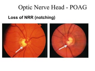 Glaucoma | PPT