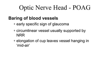 Glaucoma | PPT