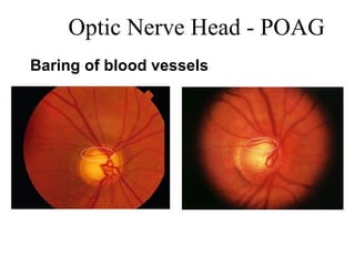 Glaucoma | PPT